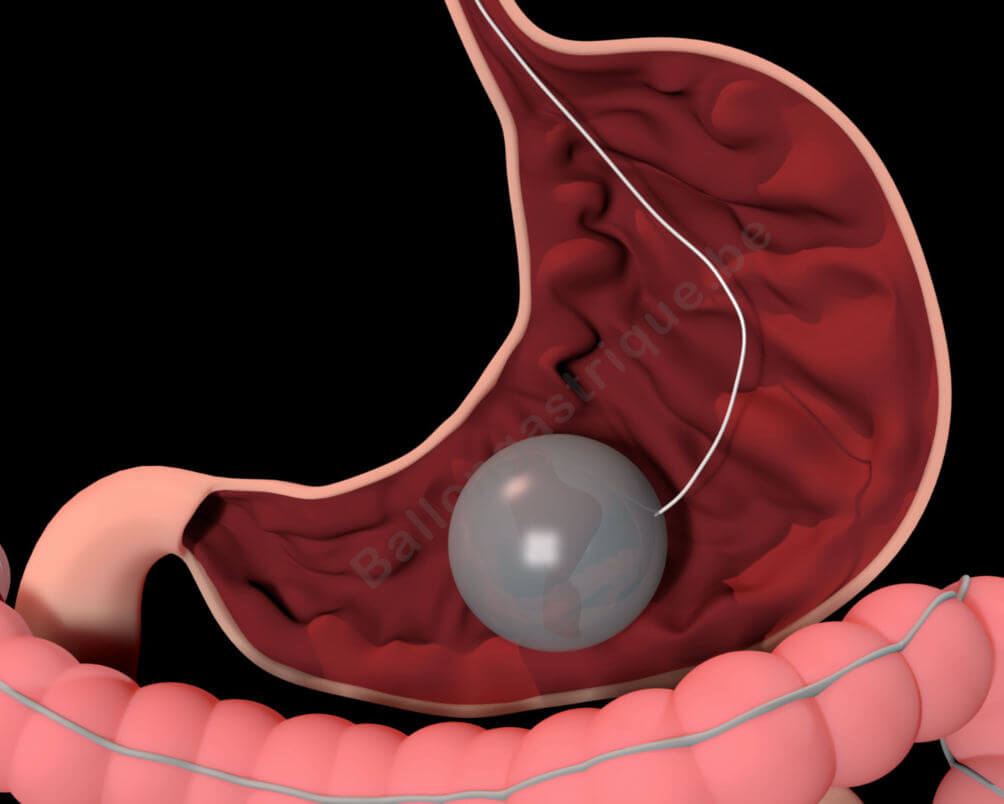 Installing the intragastric balloon: how is it going?